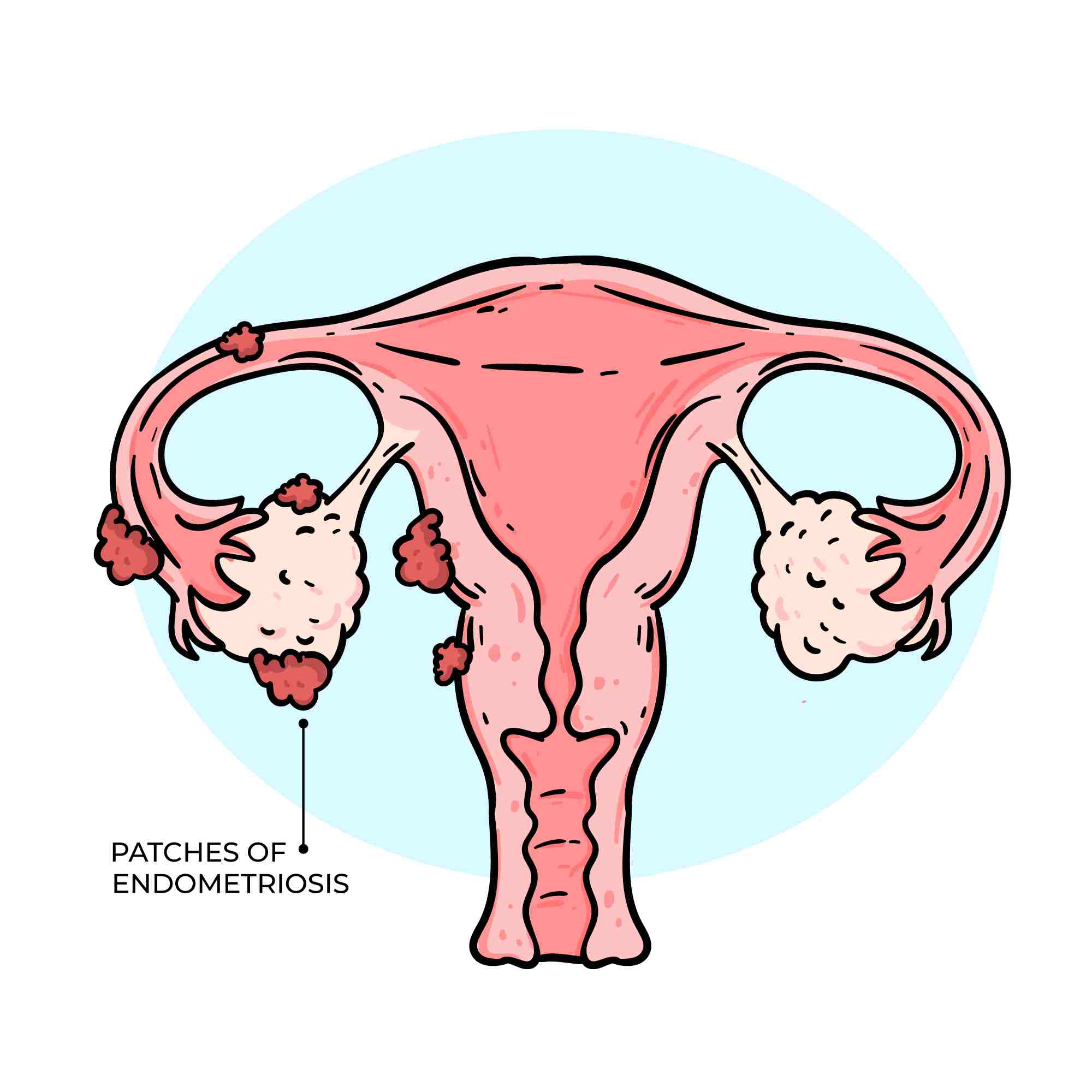 Endometrioza: simptomi, uzroci, otkrivanje - Millenium Medic - Slavija ...